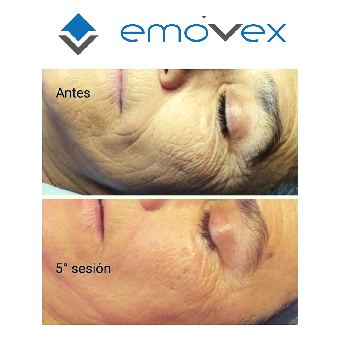 Post Tratamiento con Radiofrecuencia Bipolar- Emovex